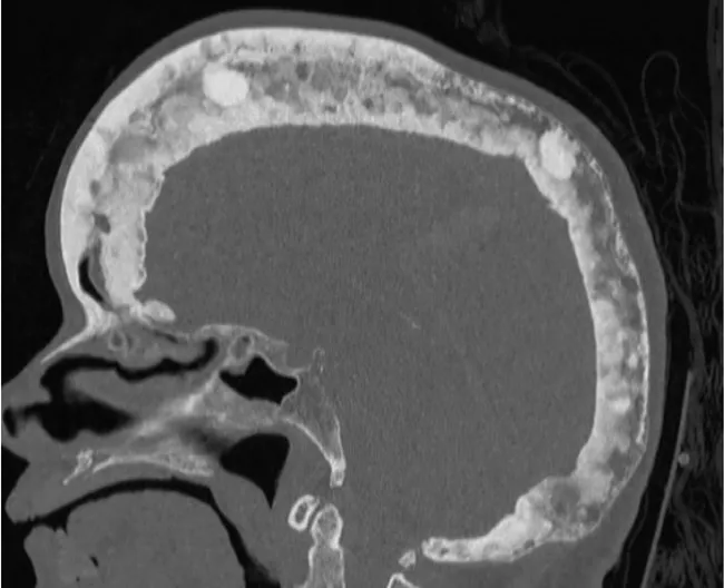 Paget Disease of Bone : Radiology
