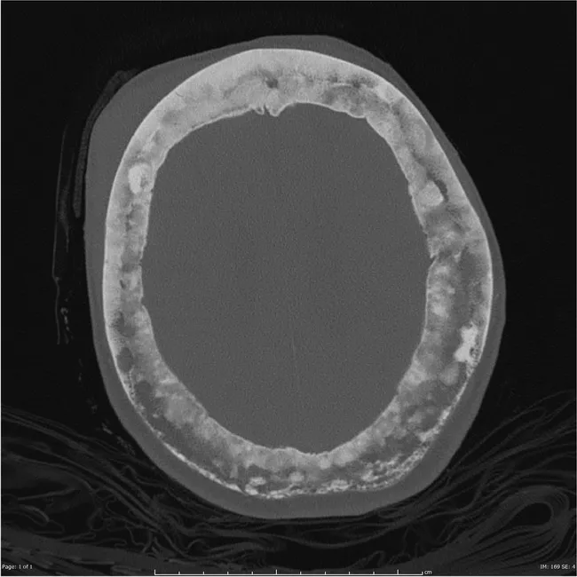 Paget Disease of Bone : Radiology
