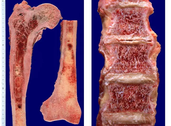 Paget Disease of Bone : Gross Pathology