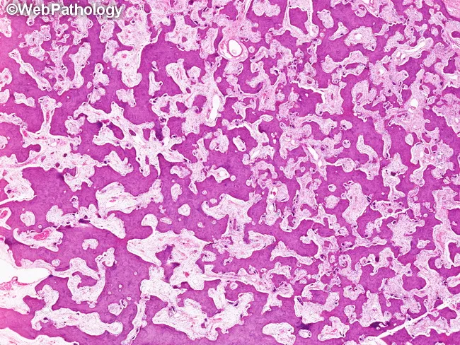 Paget Disease of Bone : Microscopic