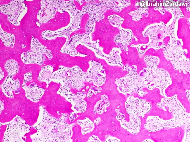 Paget Disease of Bone : Microscopic