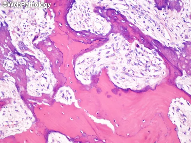 Paget Disease of Bone : Microscopic