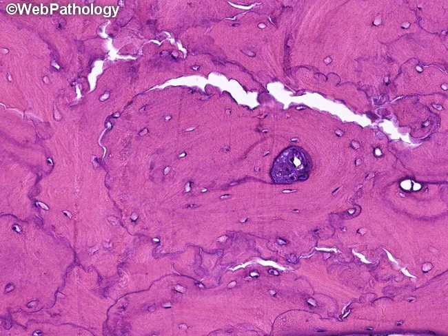Paget Disease of Bone : Microscopic