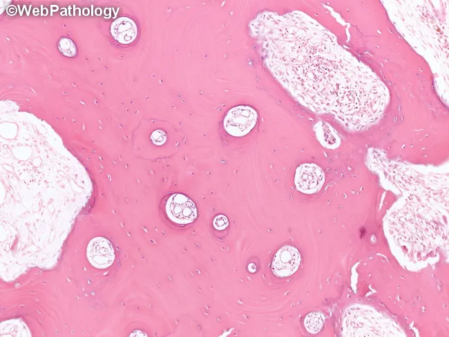 Paget Disease of Bone : Microscopic