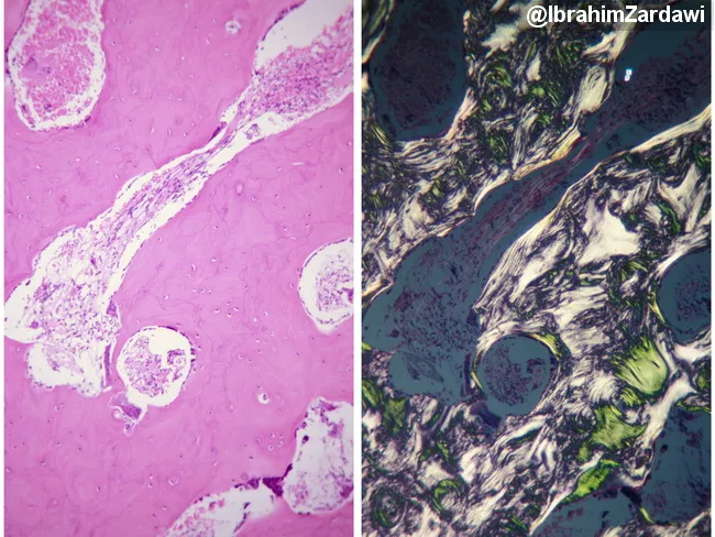 Paget Disease of Bone : Polarized Light