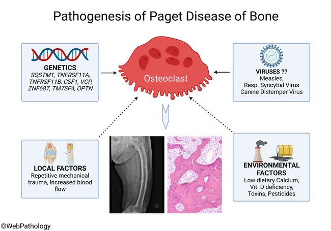 Paget Disease of Bone : Pathogenesis