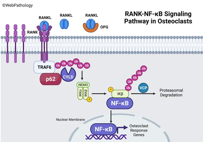 Paget Disease of Bone : RANK-NF-κB signaling