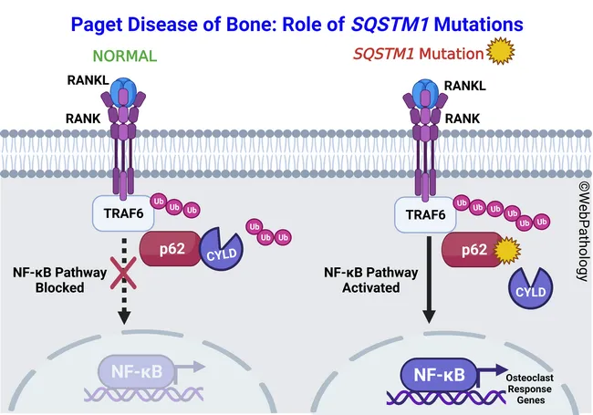 Paget Disease of Bone :SQSTM1Mutation