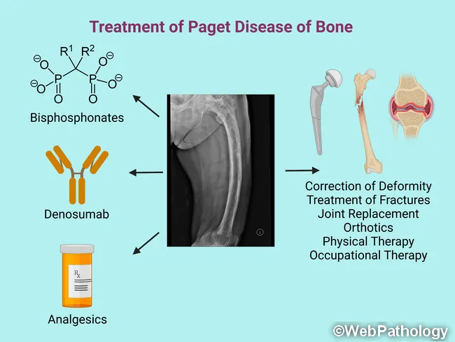 Paget Disease of Bone : Treatment