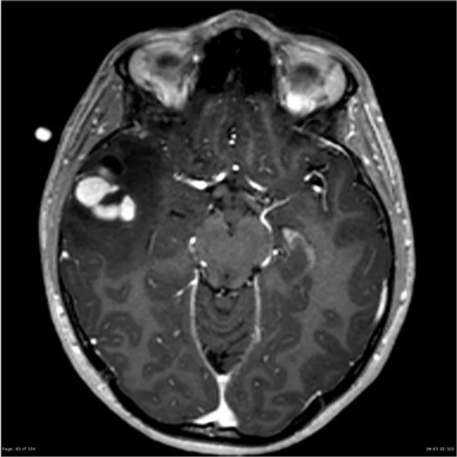 Pleomorphic Xanthoastrocytoma : MRI