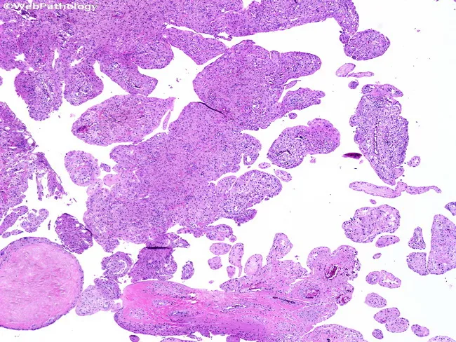 Pigmented Villonodular Synovitis