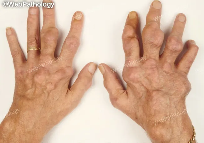 Gout : Introduction