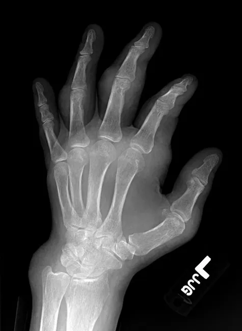 Gout : Radiographic Features
