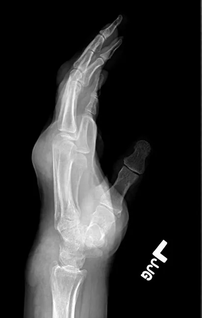 Gout : Radiographic Features