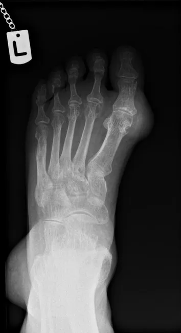 Gout : Radiographic Features