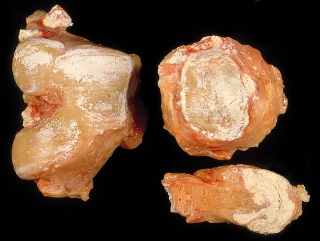 Chronic Tophaceous Gout : Gross Pathology