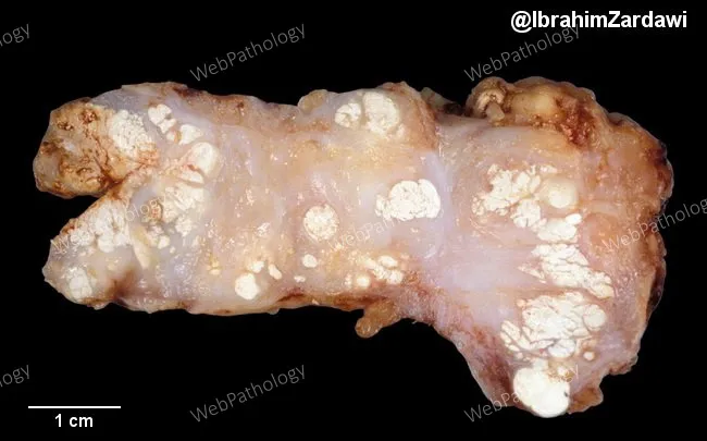 Chronic Tophaceous Gout : Gross Pathology