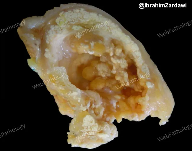 Chronic Tophaceous Gout : Gross Pathology