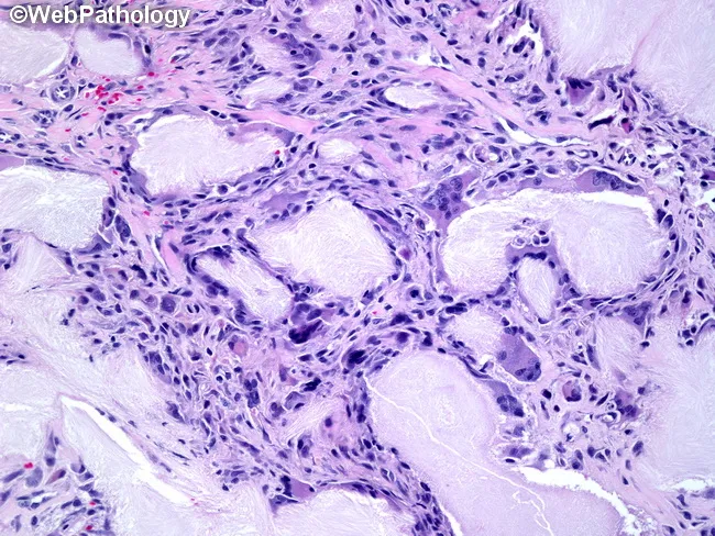 Gout : Histology