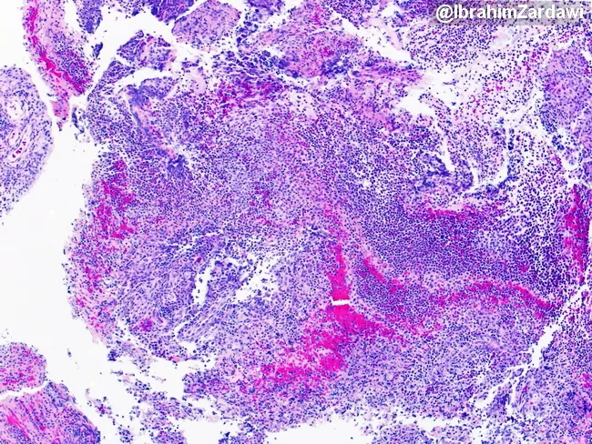 Septic Arthritis in Gout