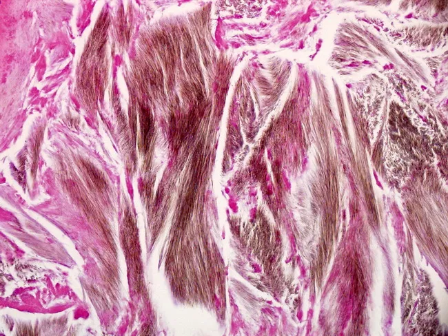 Gout : Alcohol-fixed tissues