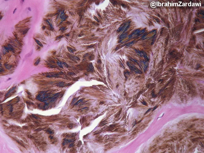 Gout : Alcohol-fixed tissues