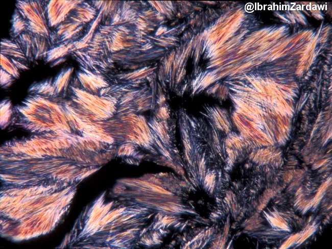 Gout : Urate Crystals