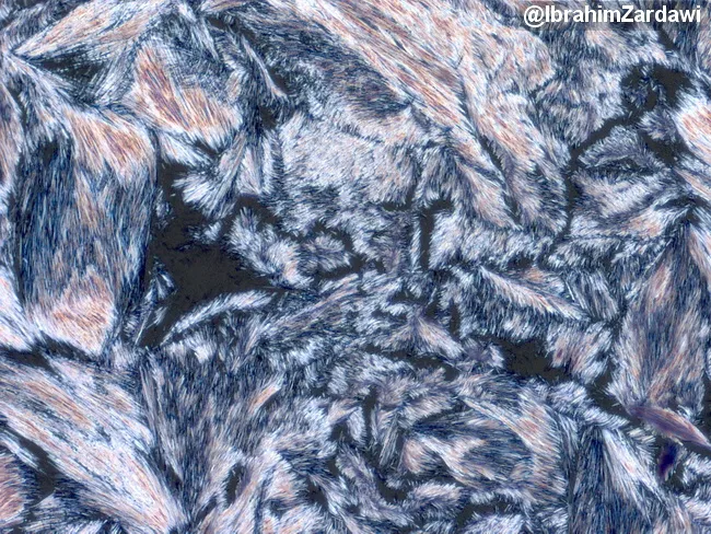 Gout : Urate Crystals