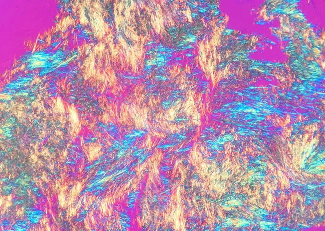 Diagnosis of Gout : Urate Crystals in Synovial Fluid