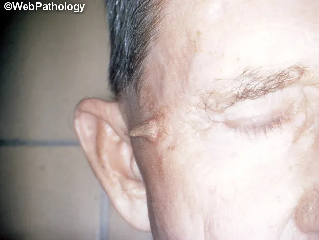 Cornu cutaneum (Cutaneous Horn)