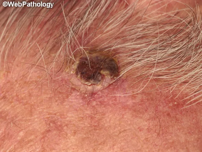 Keratoacanthoma : Clinical Presentation