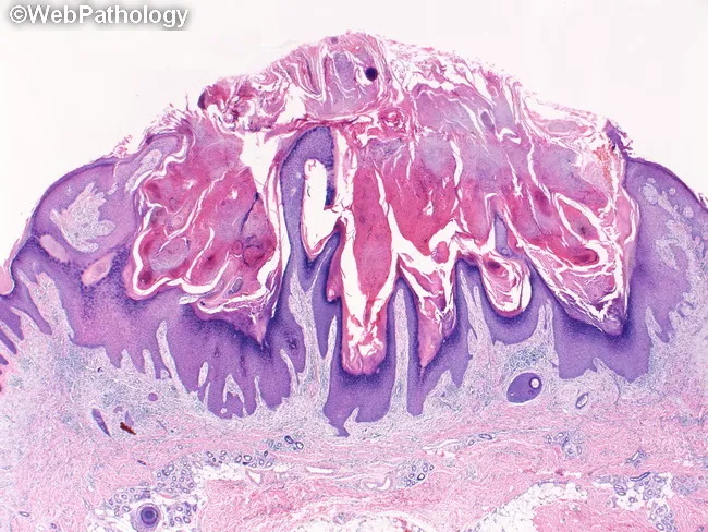 Keratoacanthoma : Histologic Features