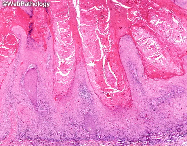 Keratoacanthoma : Histologic Features
