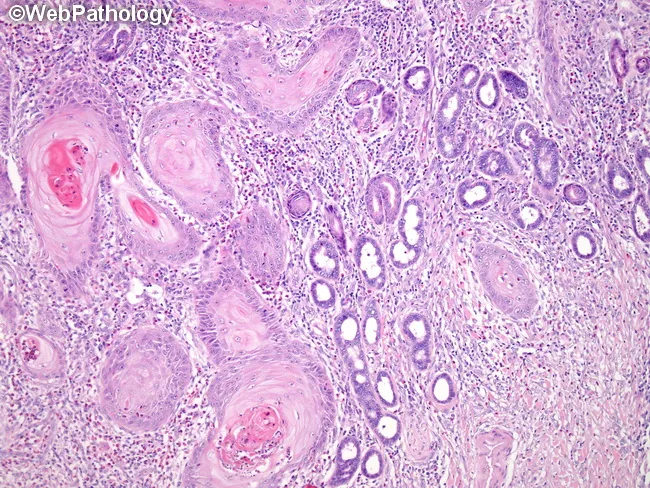 Keratoacanthoma : Sweat Duct Proliferation