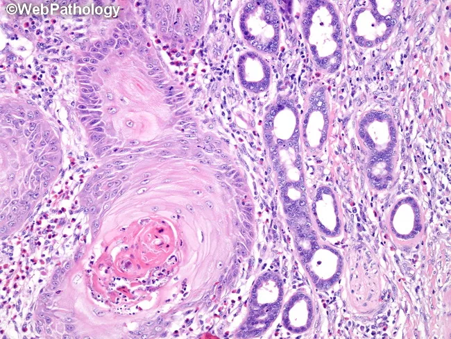 Keratoacanthoma : Sweat Duct Proliferation