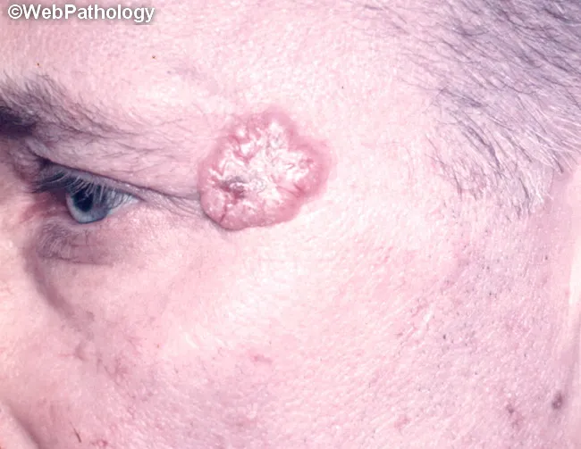 Basal Cell Carcinoma