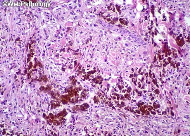 Cellular Blue Nevus Cellular Blue Nevi | Basicmedical Key