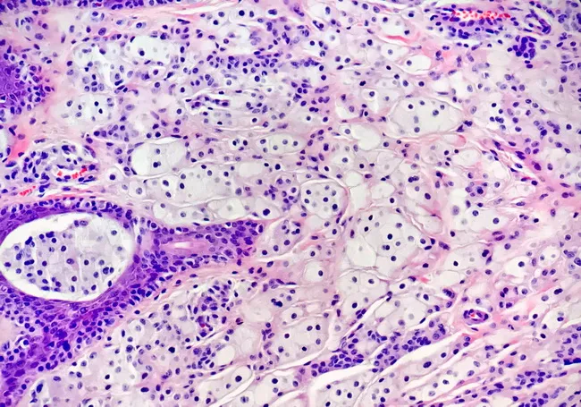 Balloon Cell Nevus