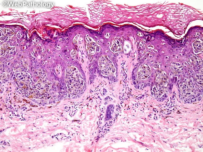 Melanoma : Radial Growth Phase