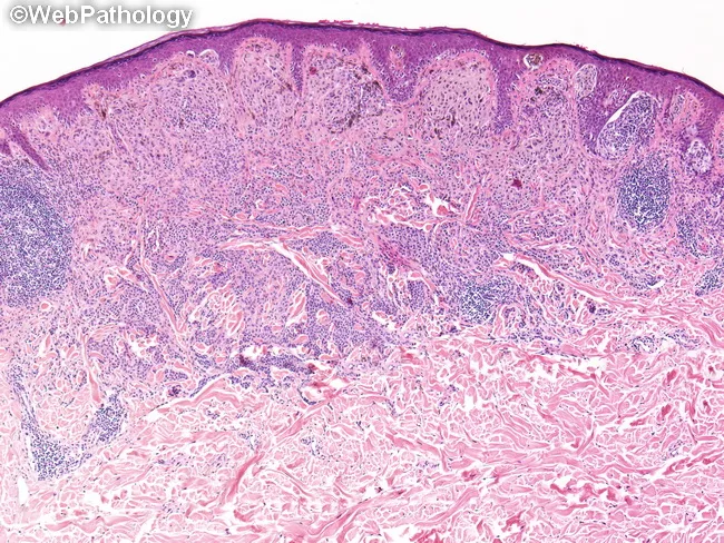 Melanoma : Breslow Thickness