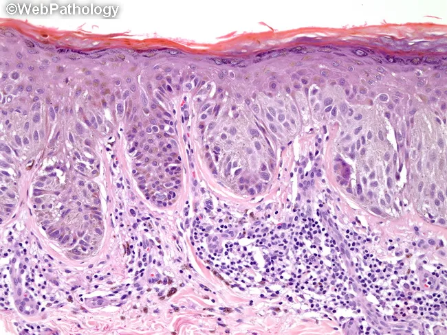 Melanoma : Clark Level 1