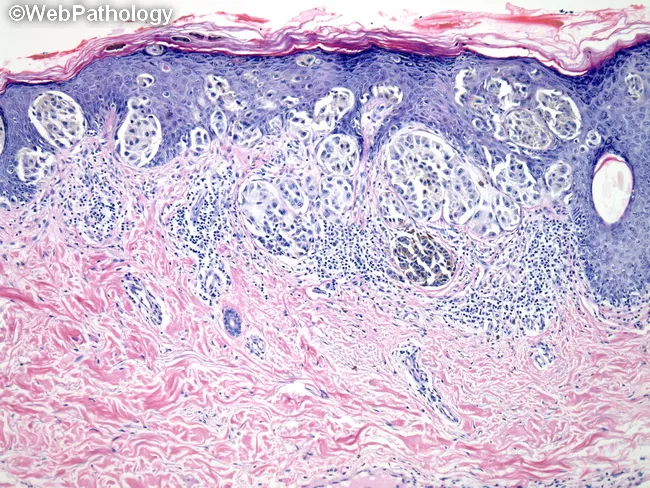 Melanoma : Clark Level 2