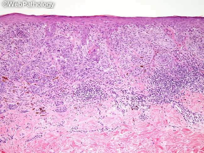 Melanoma : Clark Level 3