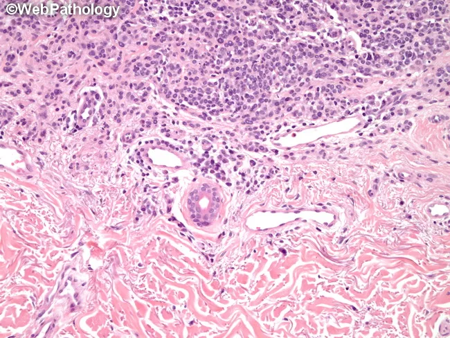 Melanoma : Clark Level 3