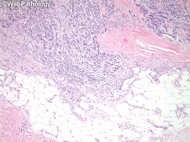 Melanoma : Clark Level 5