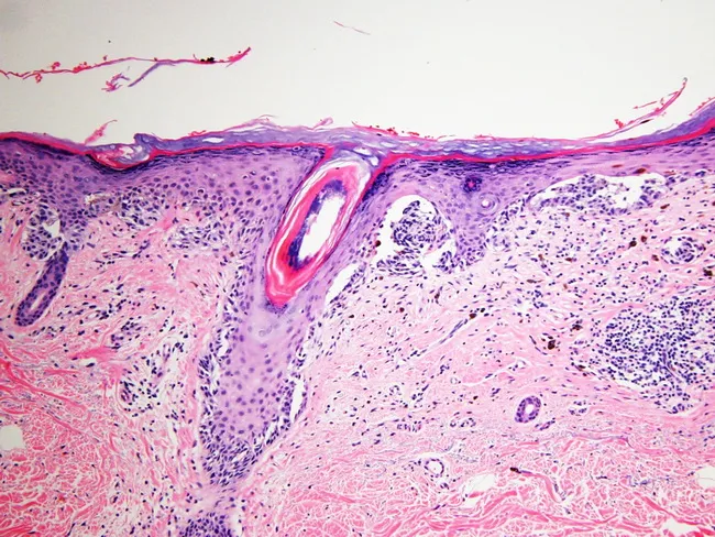 Regression in Melanoma