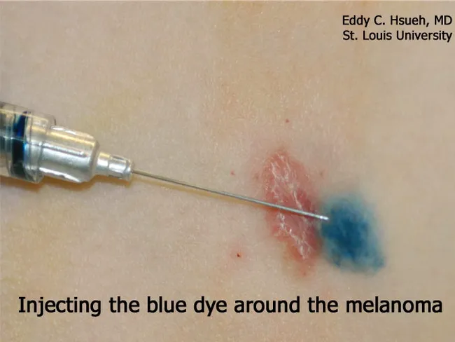 Melanoma : Sentinel Lymph Node Biopsy