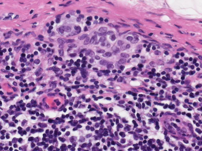Melanoma : Sentinel Lymph Node Biopsy