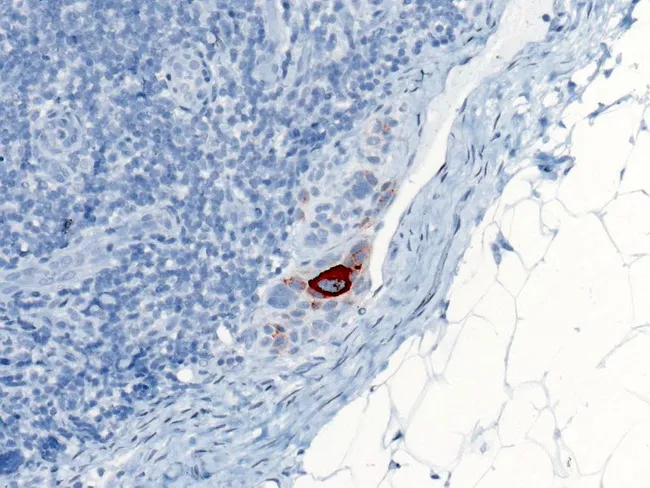 Melanoma : Sentinel Lymph Node Biopsy (HMB-45)