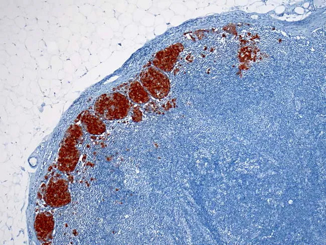 Melanoma Immunohistochemistry : HMB-45